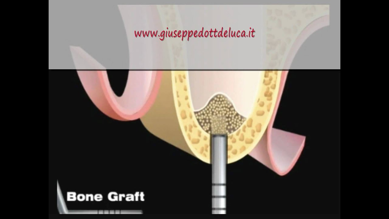 Mini sinus lift - Rialzo seno mascellare per via crestale [Demostration ...