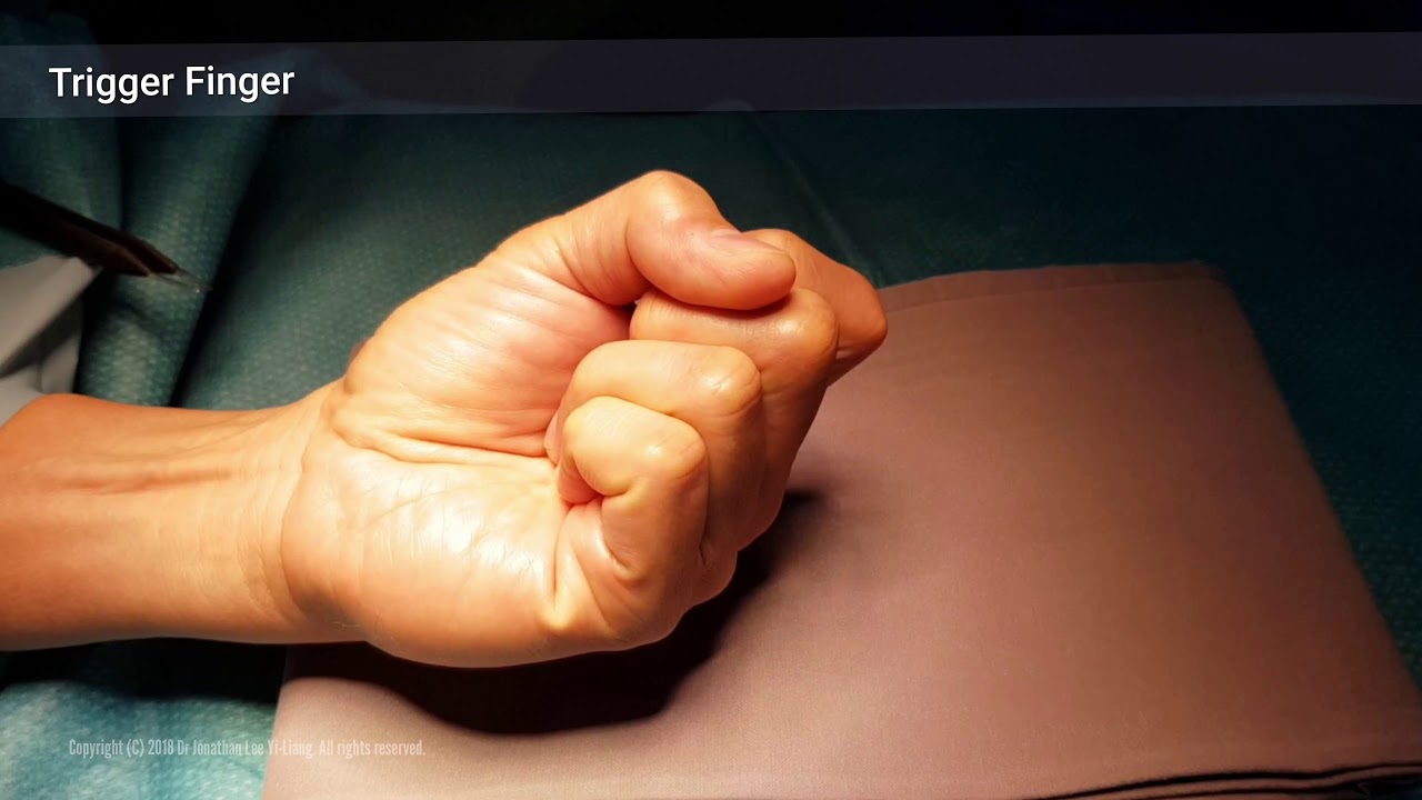 How to check if you have Trigger Finger symptom - YouTube