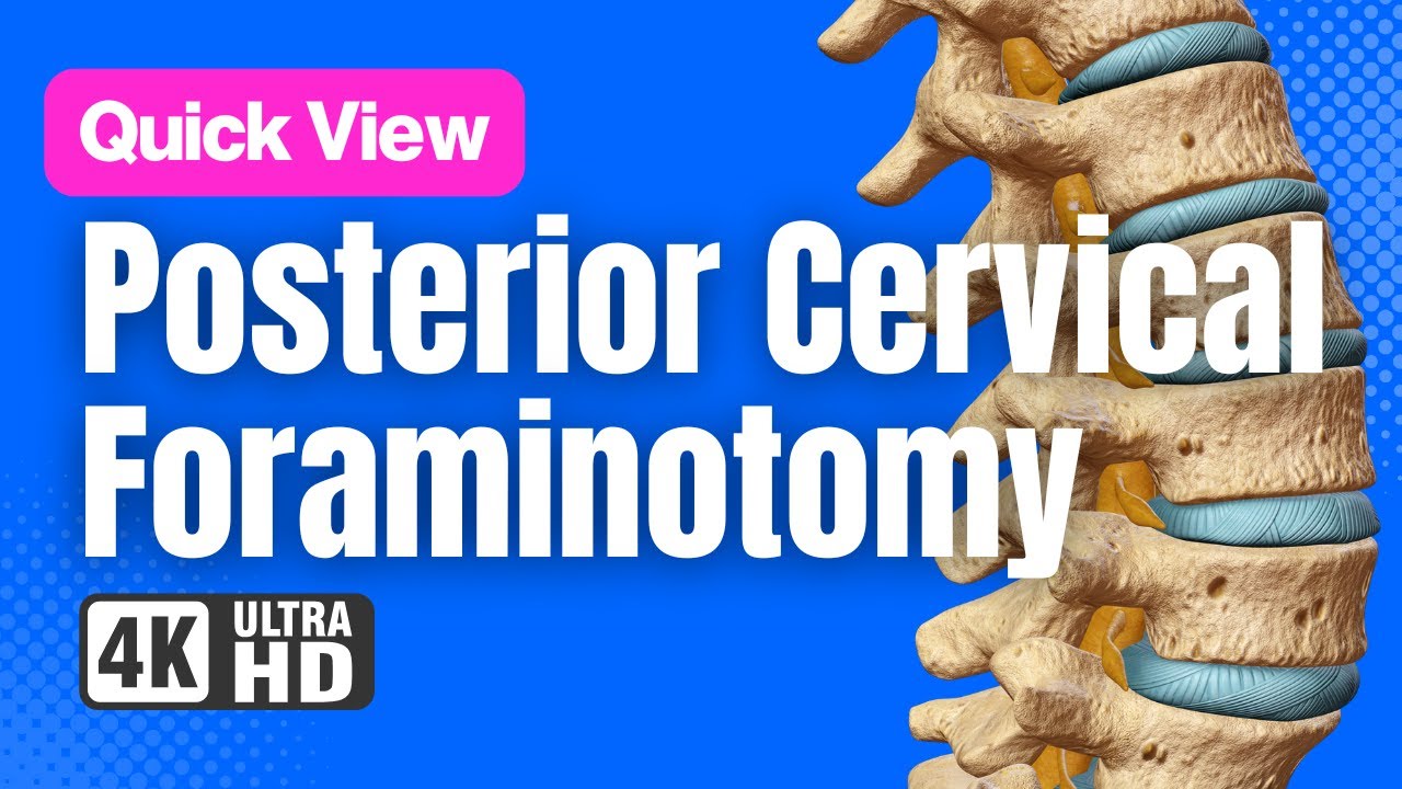 Posterior Cervical Foraminotomy // See How It Works // 3D Animation ...
