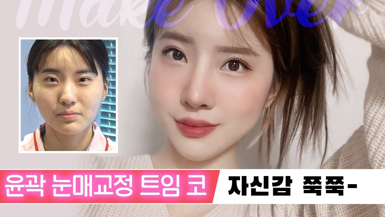 성형브이로그 너무나 만족중 👉윤곽 2종사각턱 광대 코 눈매교정 앞트임 뒤트임👈 코성형후기 코성형전후 성형 브이로그 눈트임 윤곽수술후기 성형후기