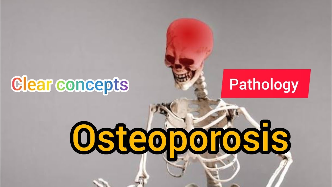 Osteoporosis Pathophysiology | Pathology | MAT Medicos - YouTube