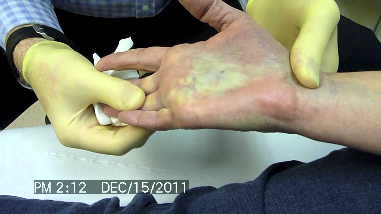 Collagenase Injection to Dupuytrens Palmar Cord - YouTube