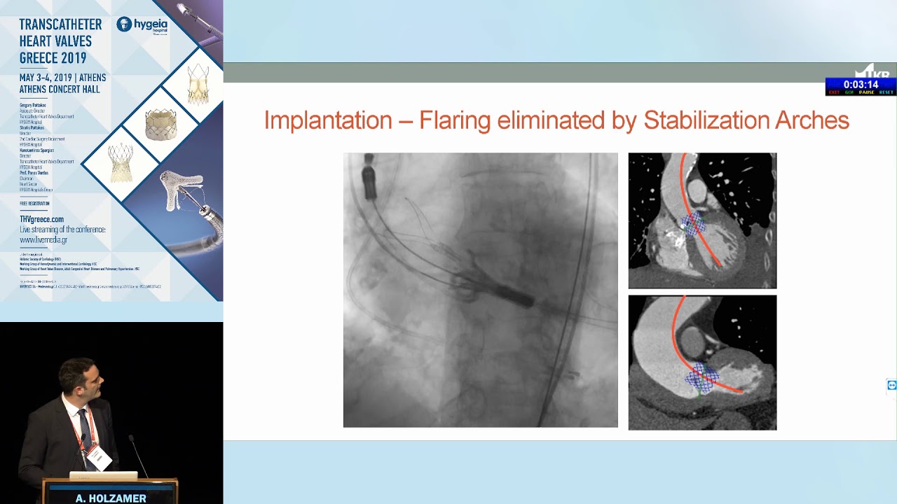 A. Holzamer| The ACURATE Neo TAVR system. - YouTube