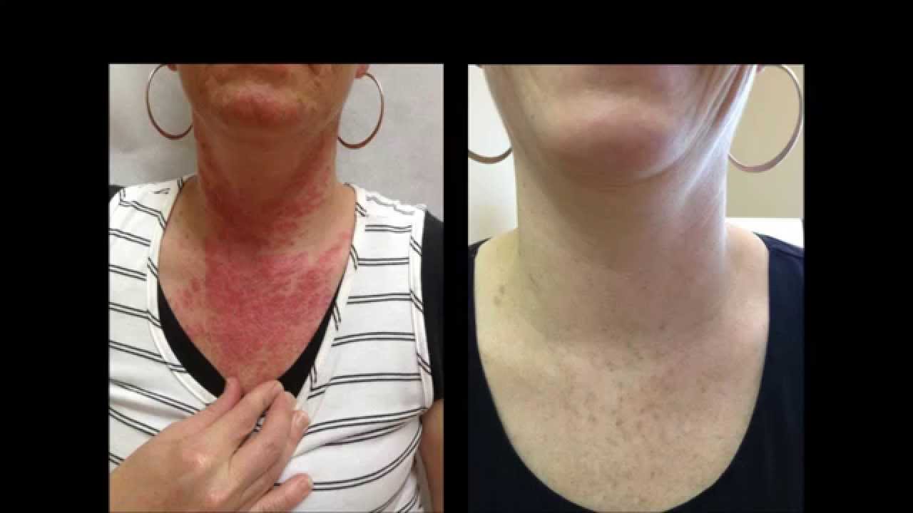 Subacute Cutaneous Lupus Finally Gone after years of Suffering! - YouTube