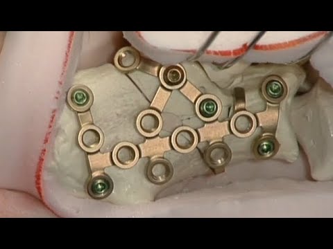 Calcaneus - Intraarticular Fracture - Fixation Using the Calcaneal ...