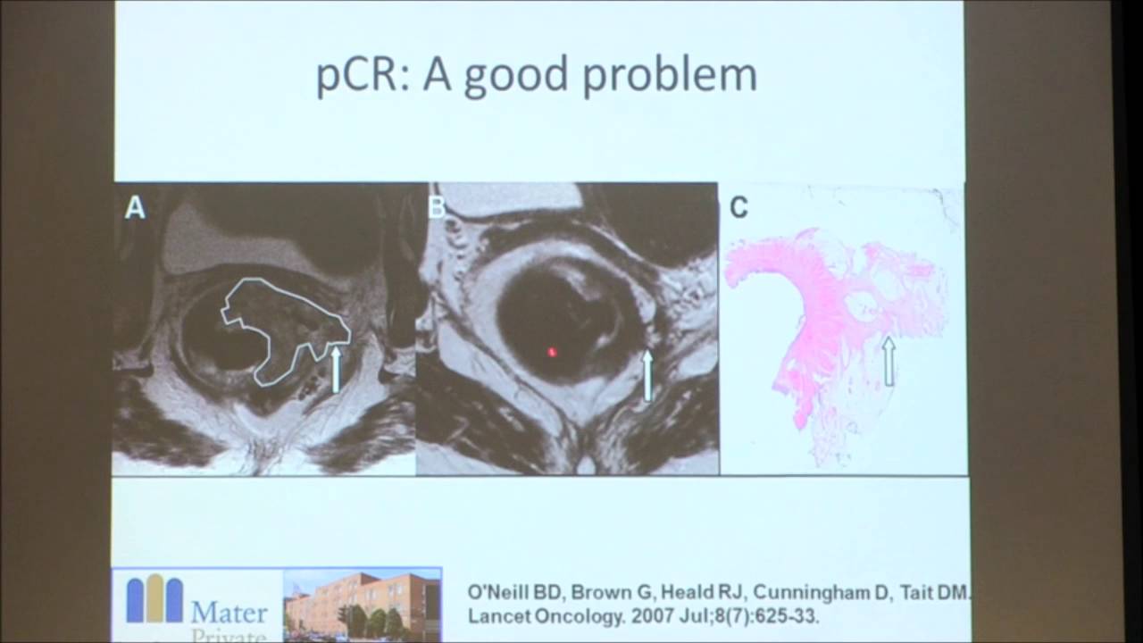 Radiotherapy for Rectal Cancer, Evolution and Current Status - YouTube