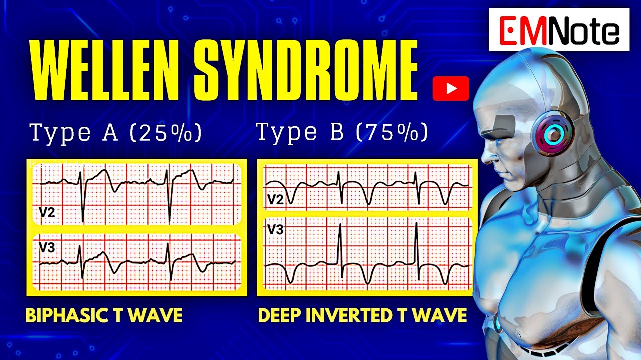 Wellens syndrome - YouTube