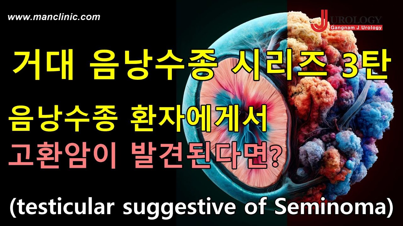거대 음낭수종 시리즈 3탄 // 음낭수종 환자에게서 고환암이 발견된다면? Rt. Huge Hydrocelectomy ...