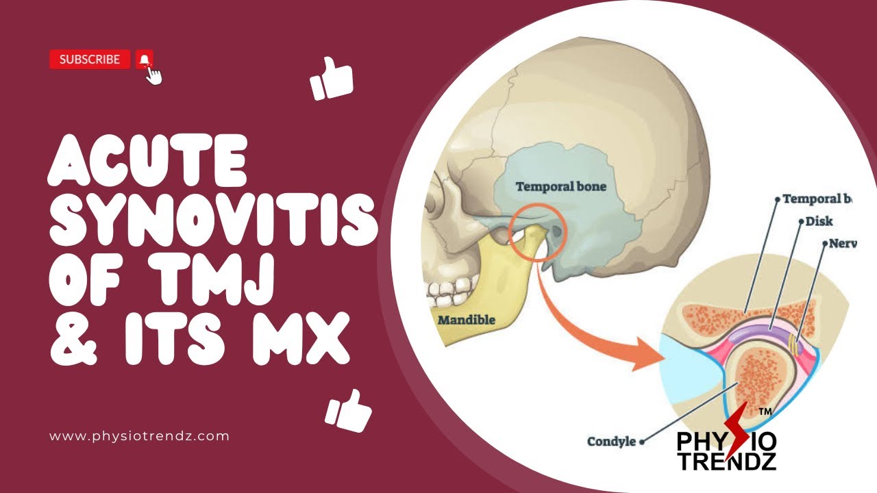 TMJ Synovitis Treatment in Acute stage: Physioquest series , Answer ...