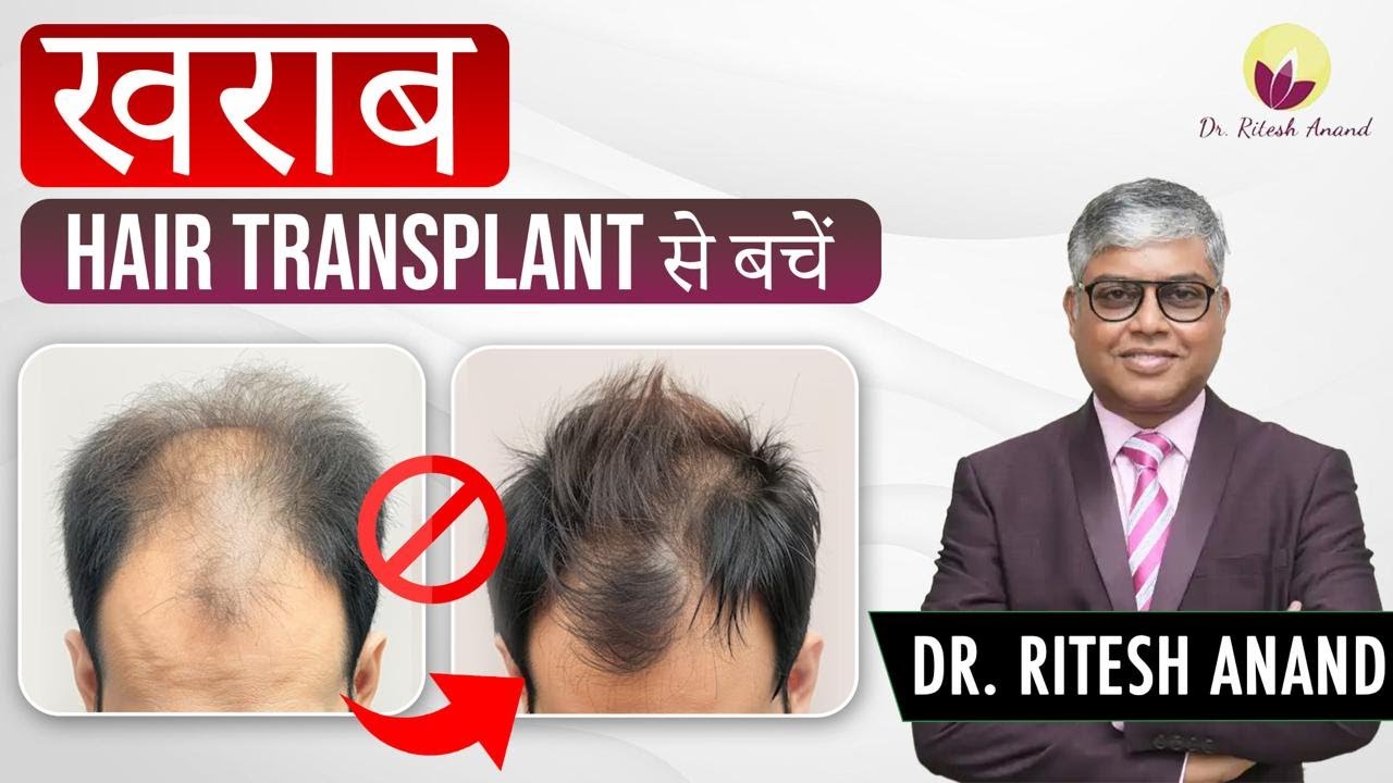 How to avoid Bad hair Transplant? | Best Hair Transplant in India | Dr ...