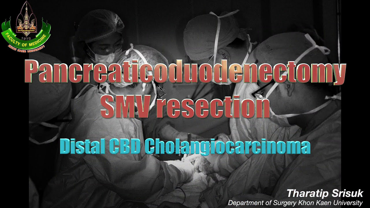 Pancreaticoduodenectomy SMV Resection - YouTube