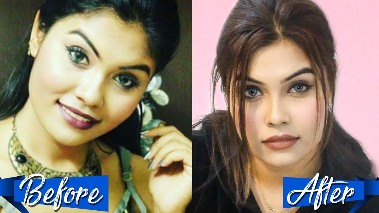 Plastic surgery in India | Results | Before & after | Ishita Chanda ...