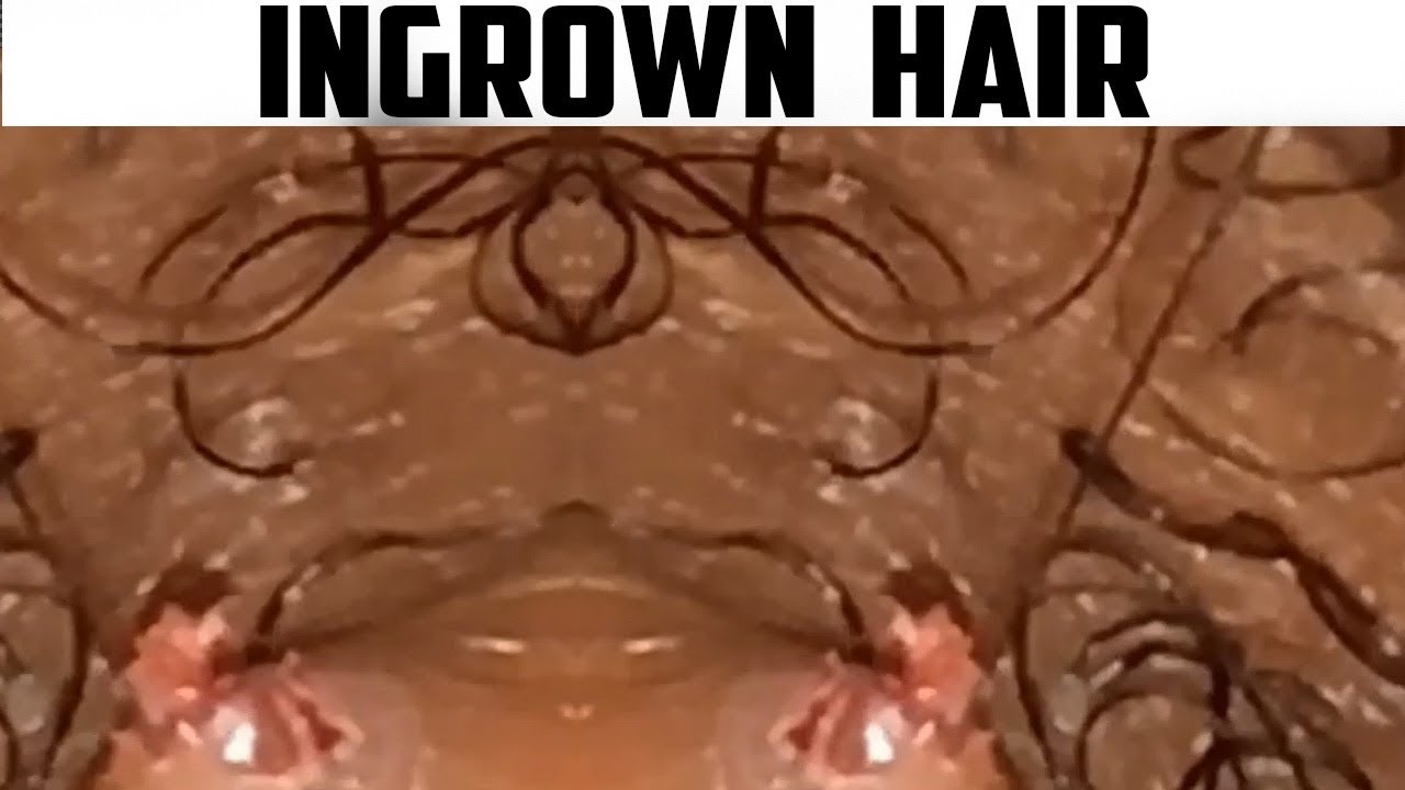 Ingrown Hair Removal Youtube