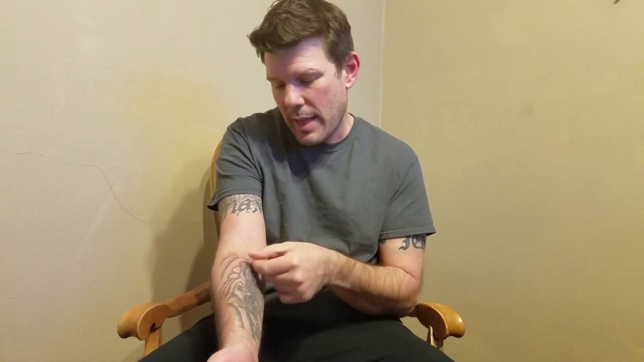 Distal bicep tenodesis 6 weeks post operation - YouTube