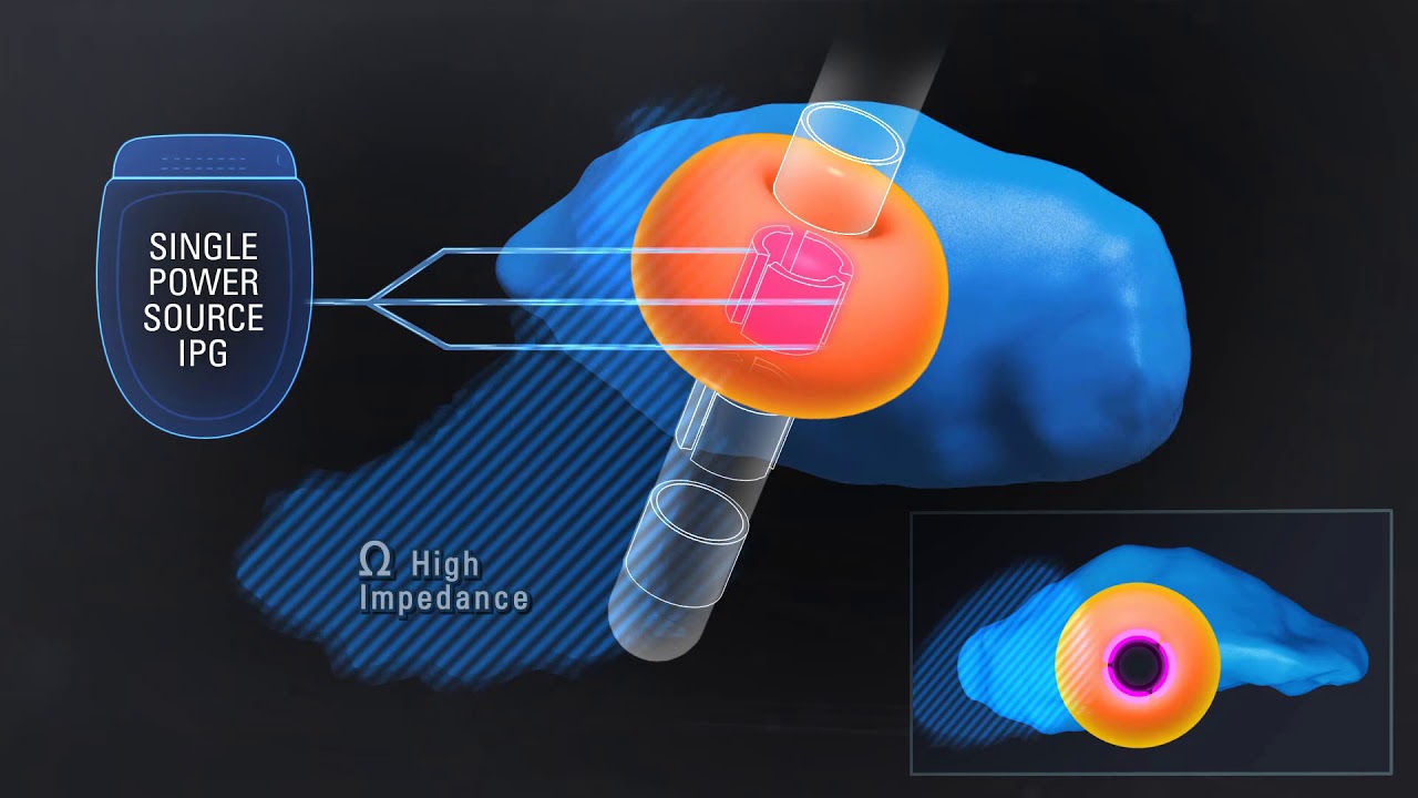 Directional DBS: Why you need a multiple source system - YouTube