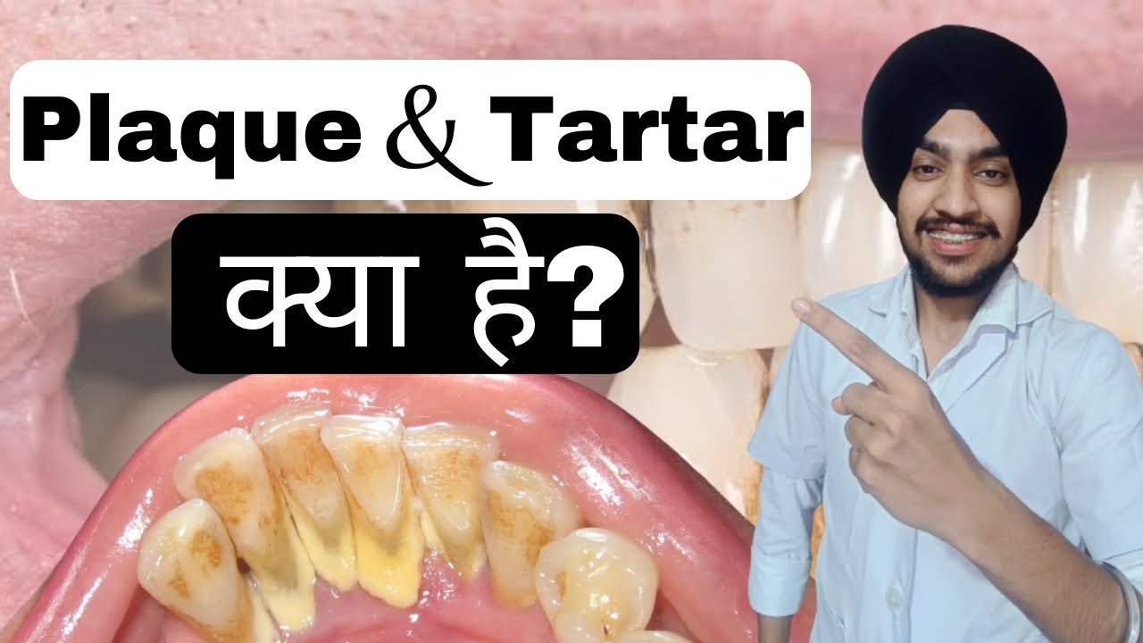 What is Plaque and Tartar | How to Remove Calculus | Treatment ...