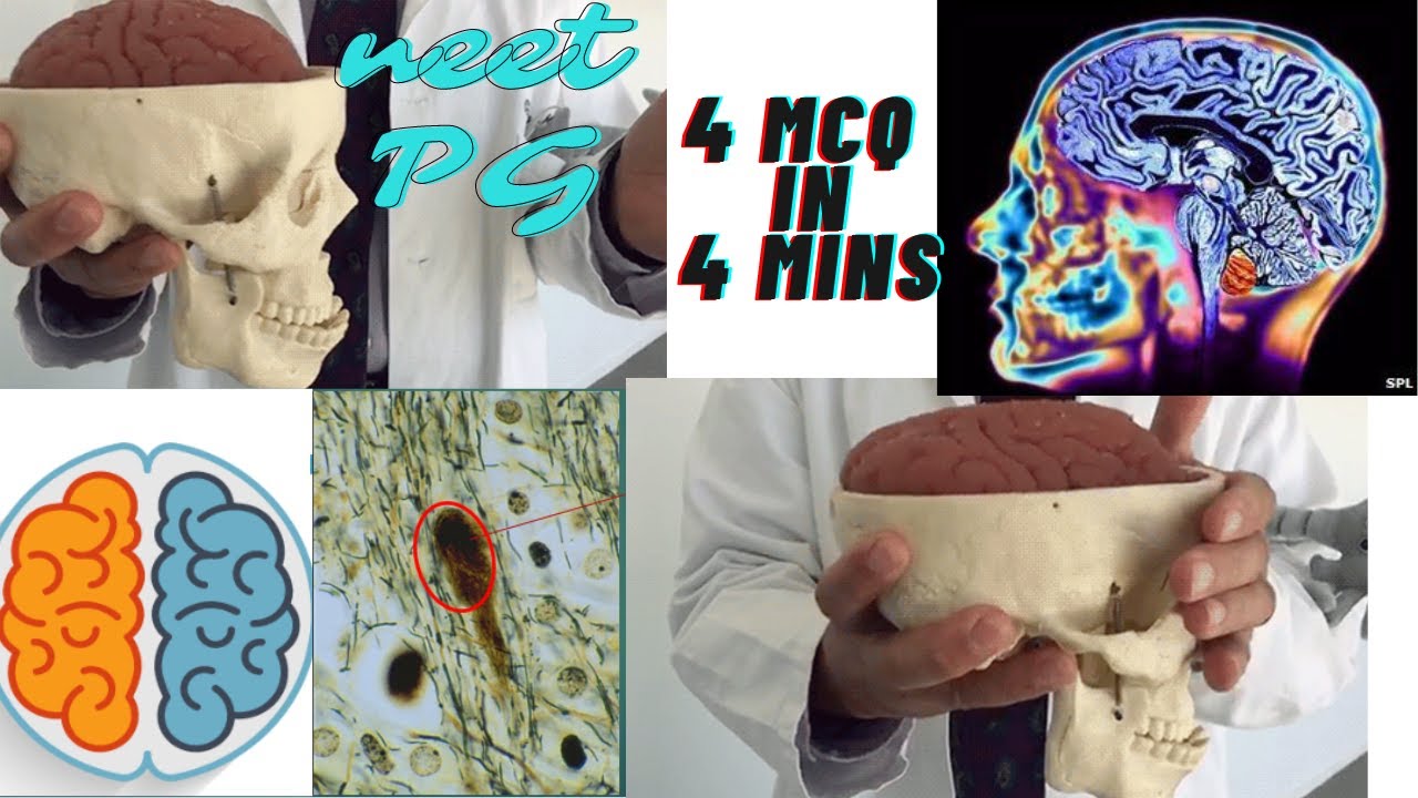 Sure Shot NEET PG MCQ: DURET Hemorrhage , Retraction BALL,DAI (Diffuse ...