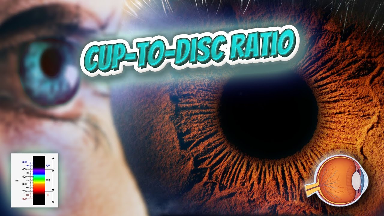 Cup to disc ratio - Your EYEBALLS - EYNTK 👁️👁️💉😳💊🔊💯 - YouTube