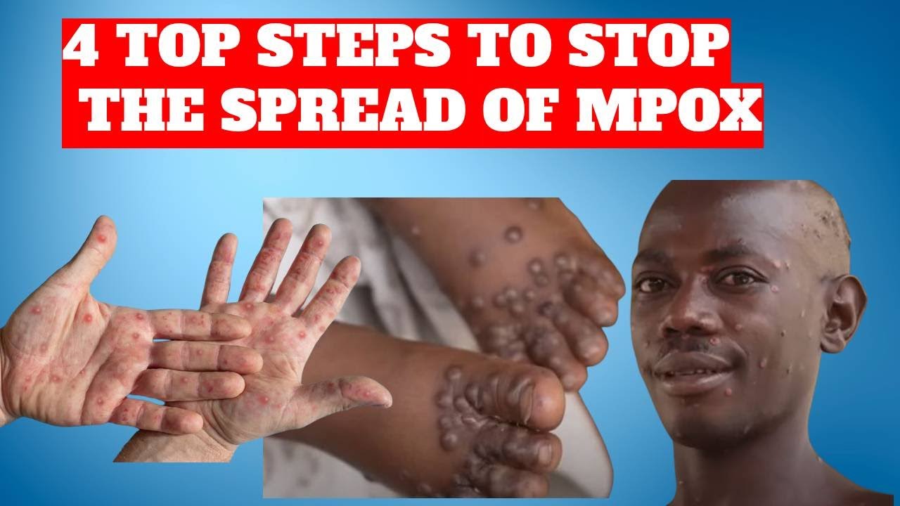 4 Top Steps To Prevent and Stop The Spread of Mpox Virus - YouTube