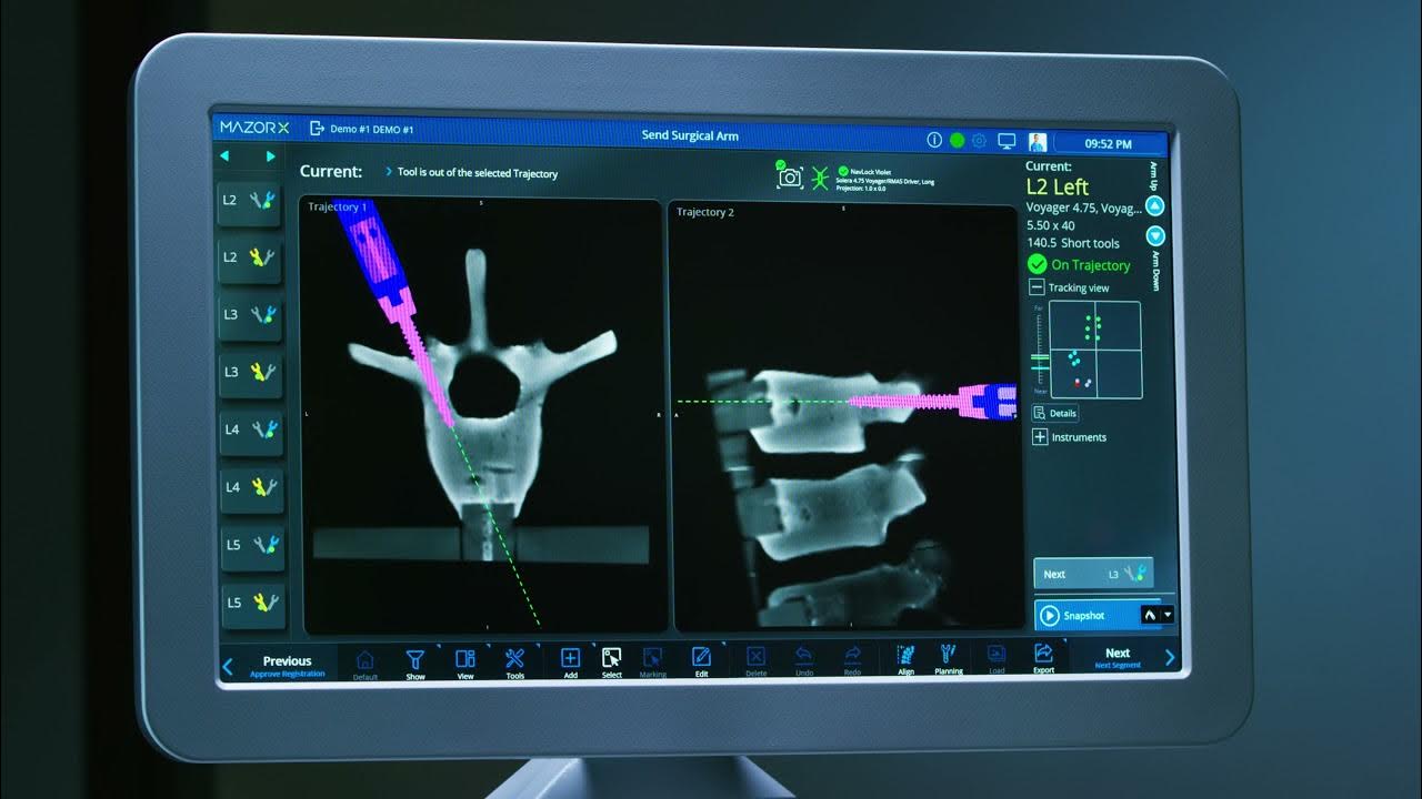 Mazor X Stealth Edition – Clip 4 - YouTube