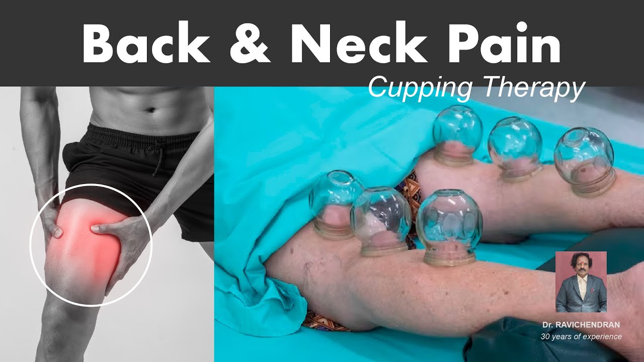 Back-pain, neck-pain Stiff-neck, leg pain - Cupping therapy treatment ...