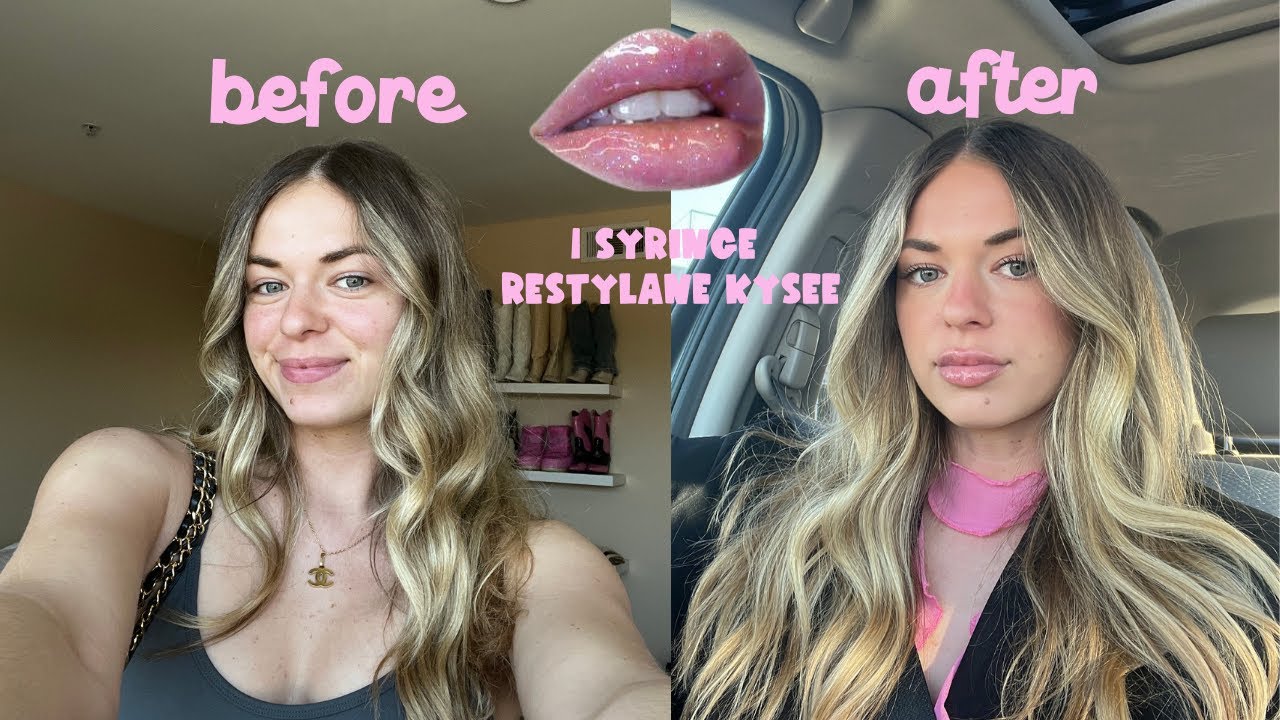 GETTING 1 SYRINGE RESTYLANE KYSEE LIP FILLER *pain level, aftercare, 2 ...