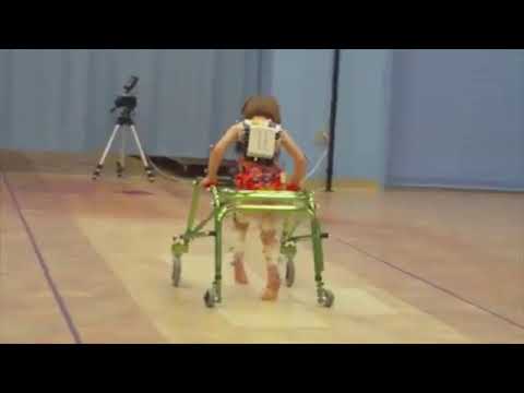 jump gait pattern, cerebral palsy , - YouTube
