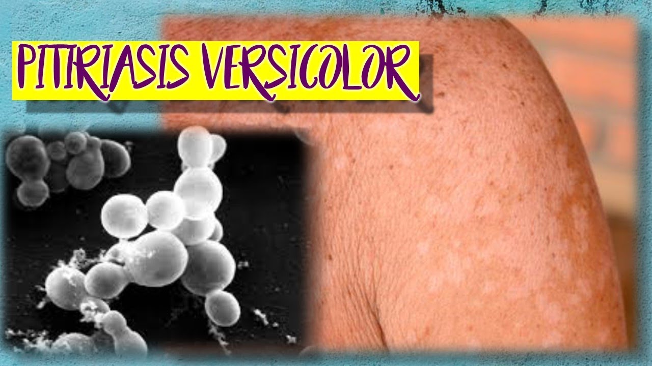 Malassezia furfur Microorganismo, Enfermedad y Tratamiento - YouTube
