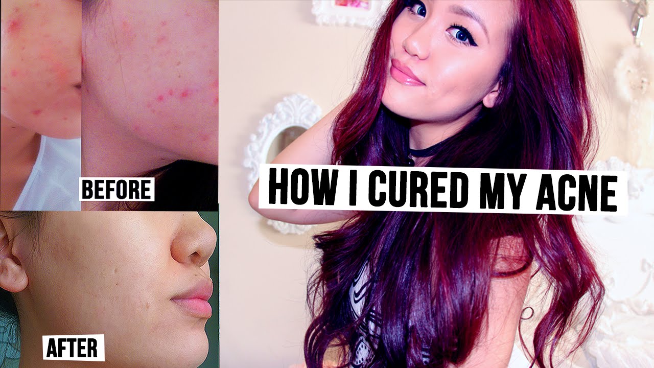 How I Finally Cleared My Skin & Bad Breakouts! - YouTube