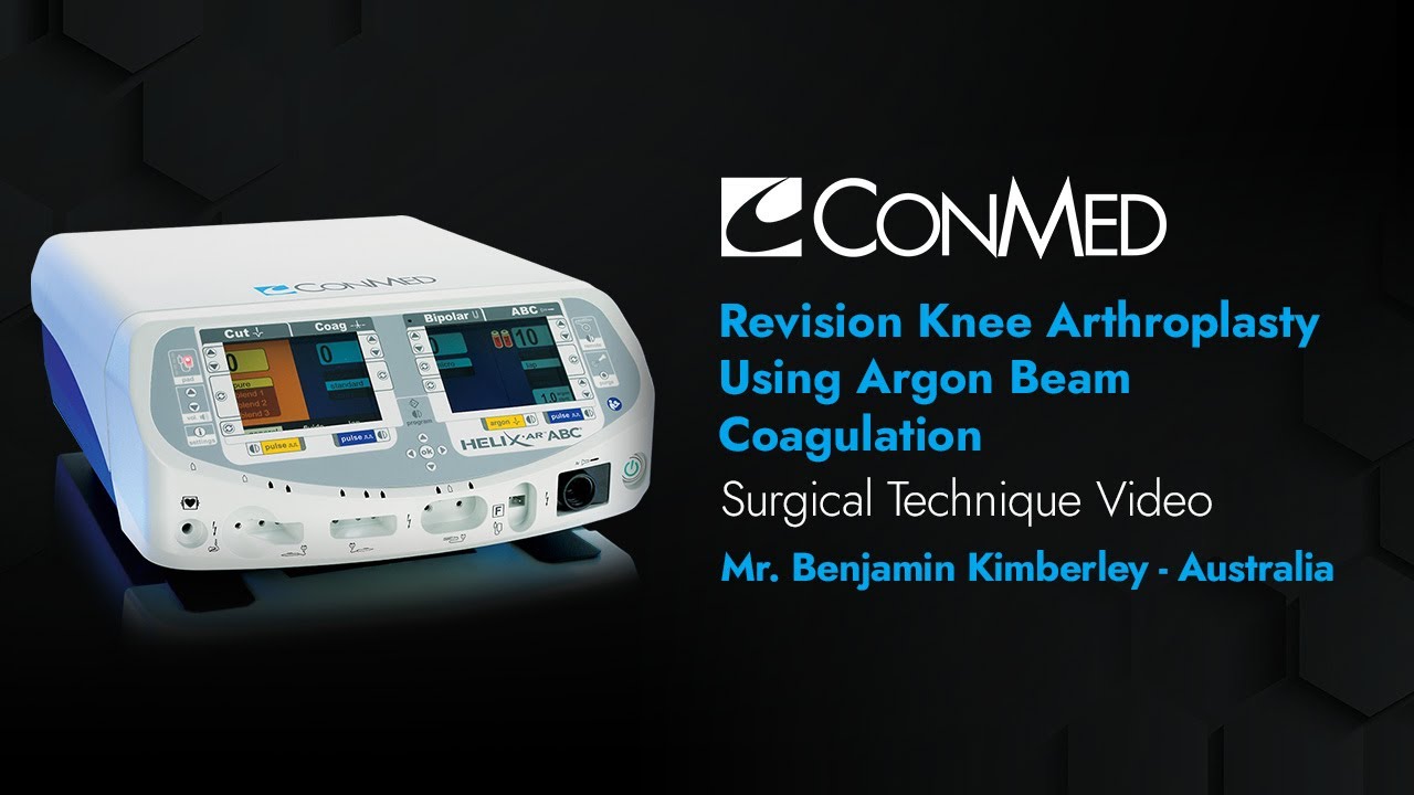 Mr. Benjamin Kimberley - Revision Knee Arthroplasty Using Argon Beam ...