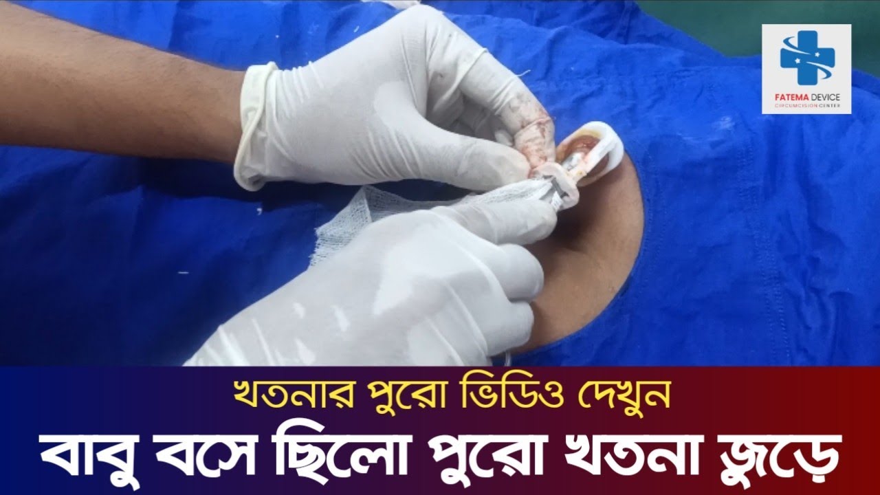 সুন্নতে খৎনা | ডিভাইস কসমেটিক খতনা | মুসলমানী | Circumcision | Khatna ...