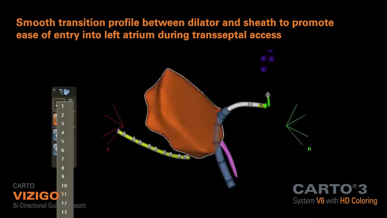 CARTO VIZIGO® Bi-Directional Guiding Sheath: Time-Lapse Case Footage ...