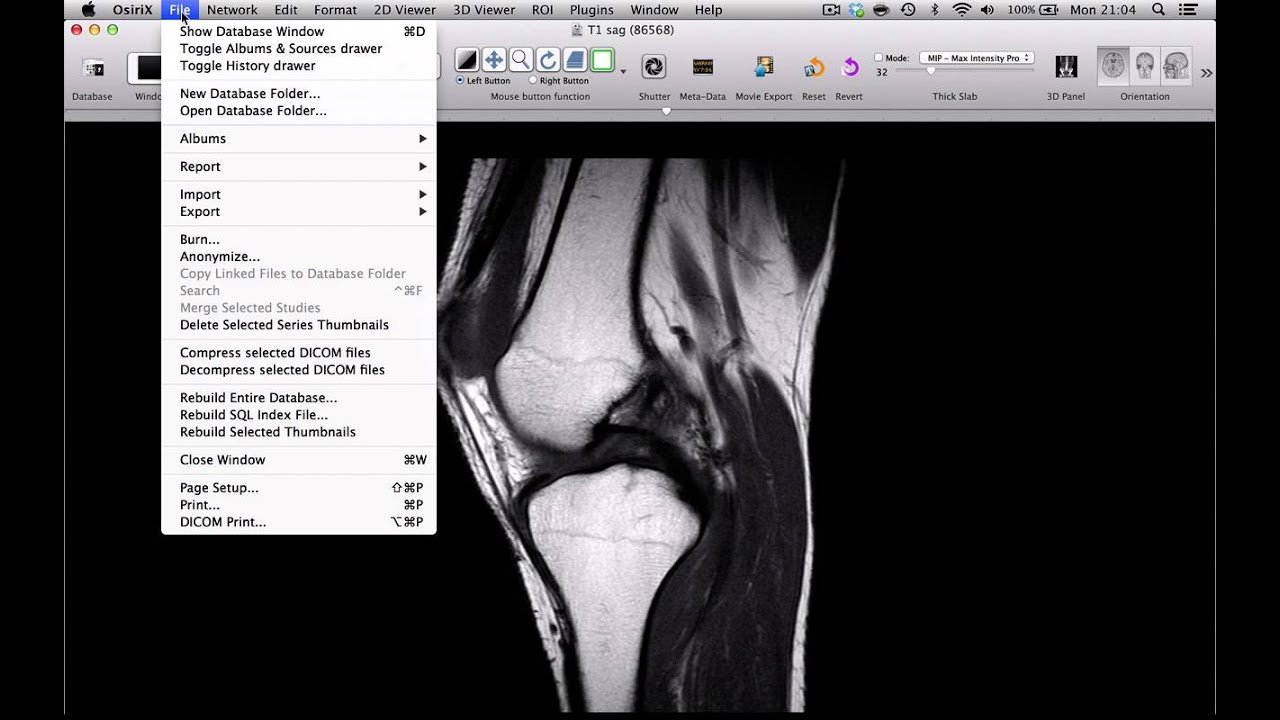 How To Import Jpeg Series Into OsiriX YouTube How To Import Jpeg Series Into OsiriX YouTube