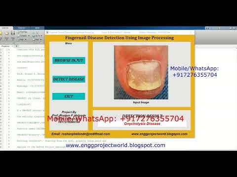 Fingernail Disease Detection Using Image Processing Matlab Project With Source Code - YouTube