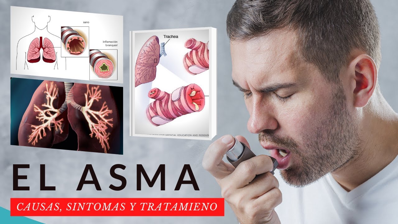 QUE ES EL ASMA | Causas Sintomas y Tratamiento, SALUD DE HOY ...