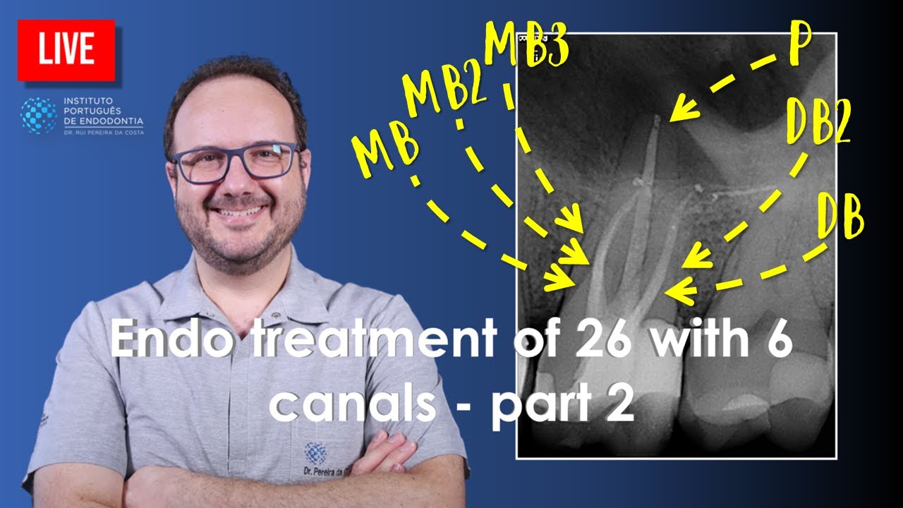 🔴 Endo treatment of 26 with 6 canals - part 2 - YouTube