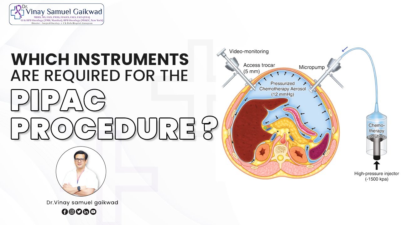 Which Instruments Are Required For the PIPAC Procedure? | Dr Vinay ...