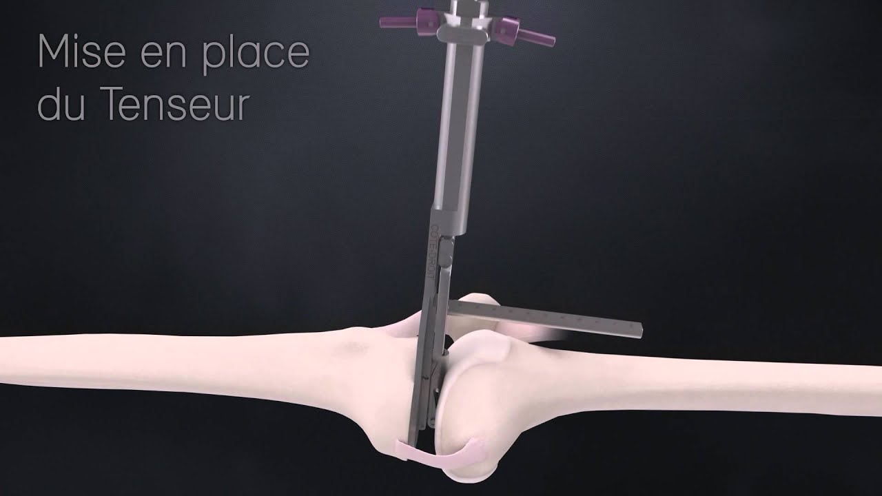 AFG - Ancillaire pour prothèse totale de genou - YouTube