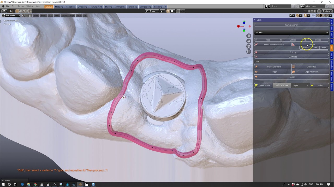 B4D Implant Analog Placement - YouTube