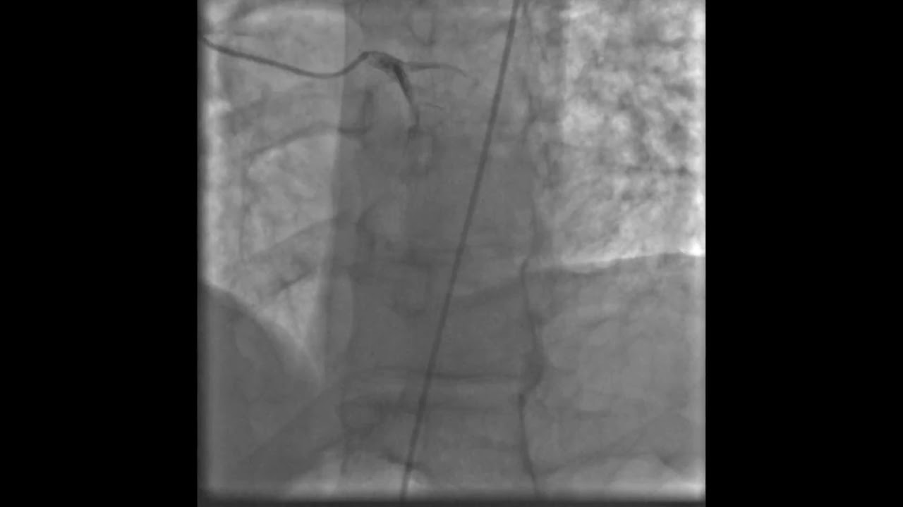 Stenting of the right coronary artery for inferior wall myocardial ...