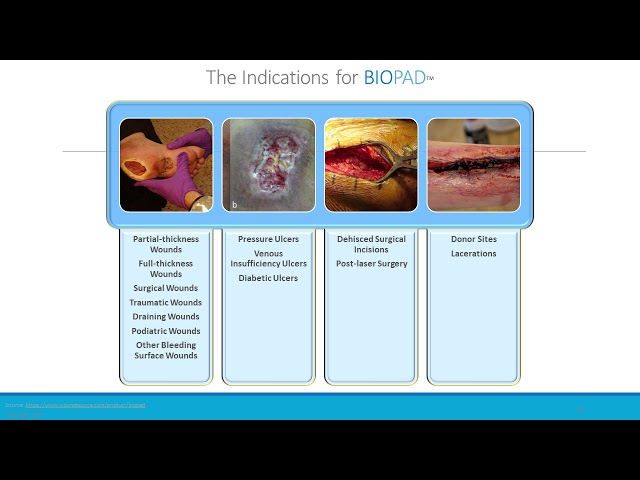 Prisma Wound Dressing Side Effects