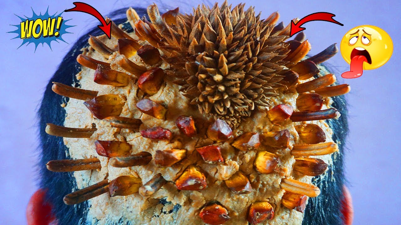 Amazing Worms Removal | Psoriasis Treatment (EP172) - YouTube