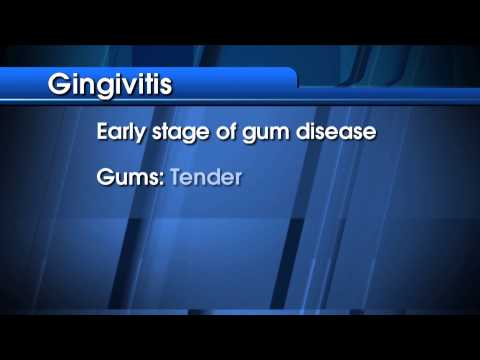 Tobacco Risks on Oral Health
