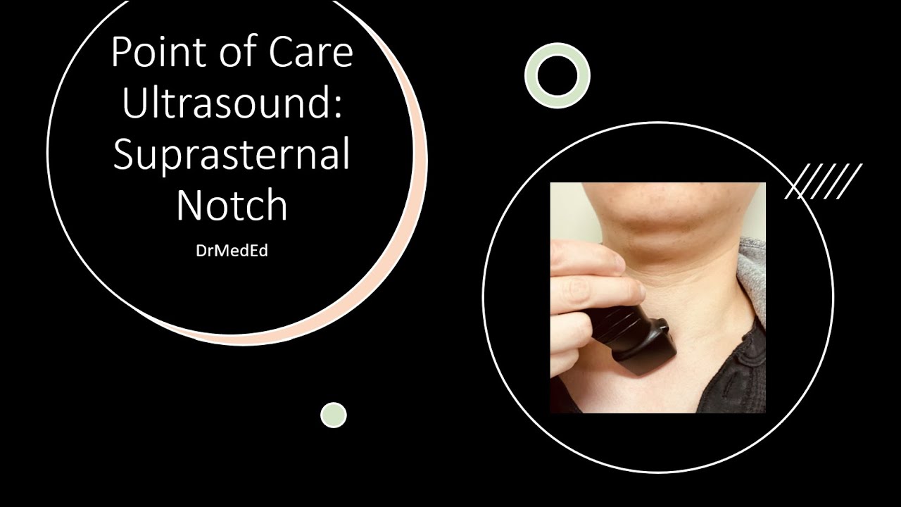 Point of Care Ultrasound (POCUS) - Suprasternal Notch View - YouTube
