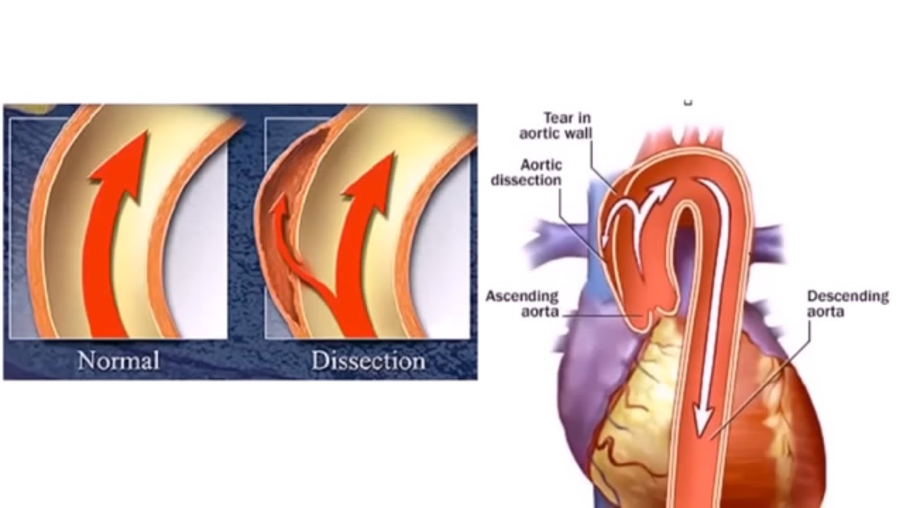 Meredith O’Neal Survived Aortic Dissection WHILE GIVING BIRTH! (Part 1 ...