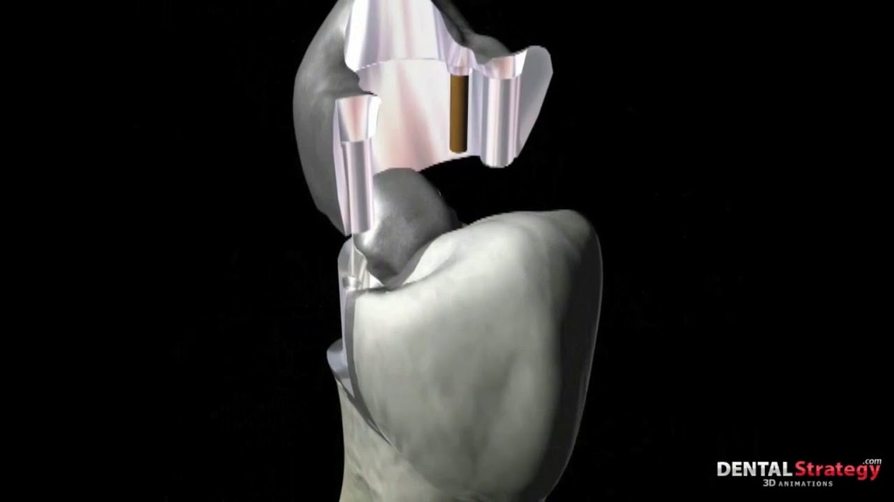 041 - Activable friction pins - YouTube