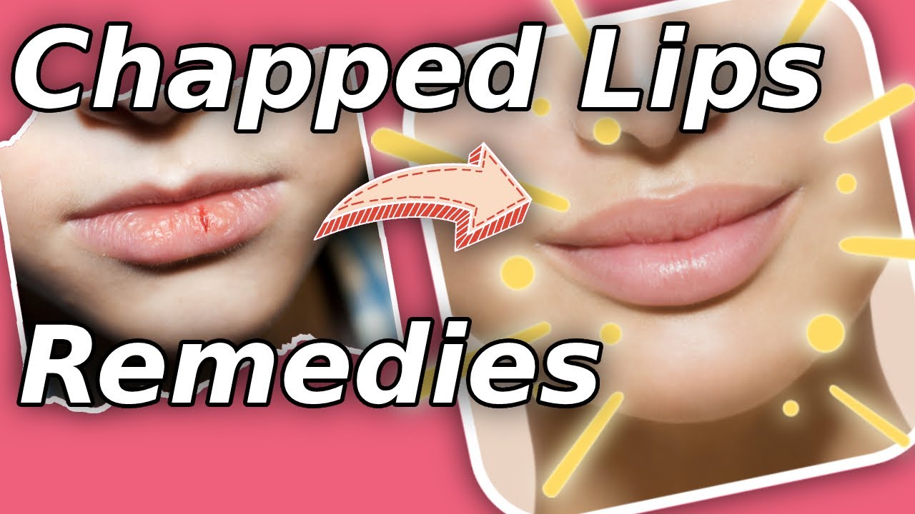 Chapped Cracked Lips Home Remedies Winter Lip Care - YouTube