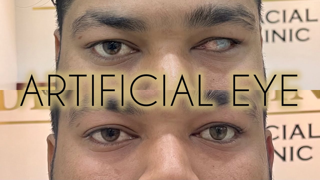 Lost eye/ Artificial Customised eye treatment for patients with ...