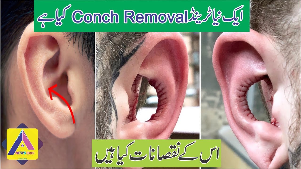 What is a New Trend Conch Removal And what are its disadvantages holes ...