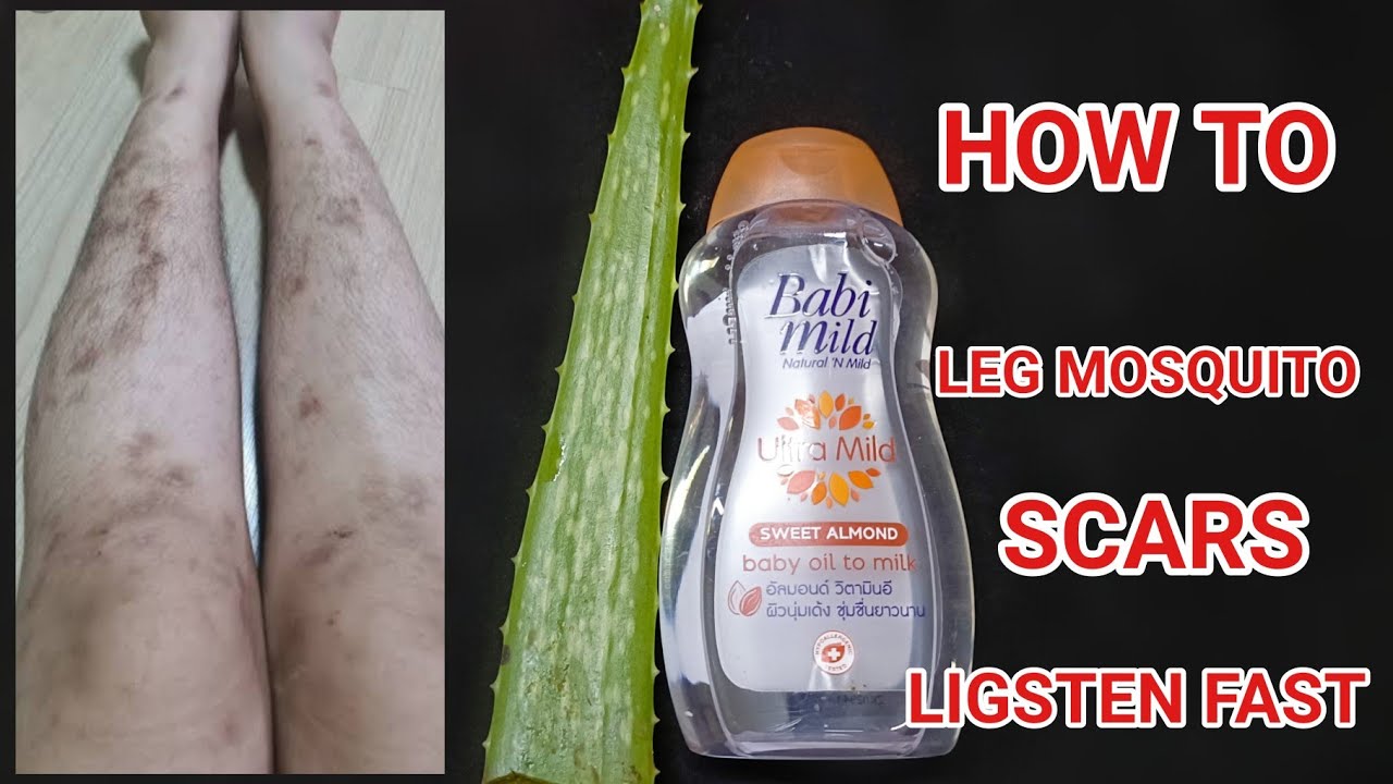 HOW MY LEG MOSQUITO LIGHTEN FAST IN 3 DAYS SCAR,MOSQUITO, BITES ON LEGS ...